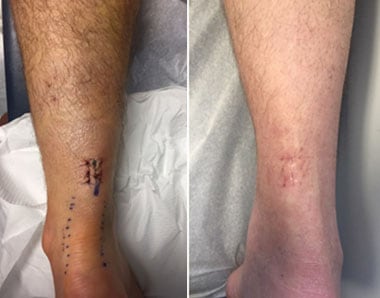 Minimally Invasive Achilles Repair | OrthoVirginia