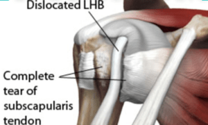 The Biceps Tendon | OrthoVirginia