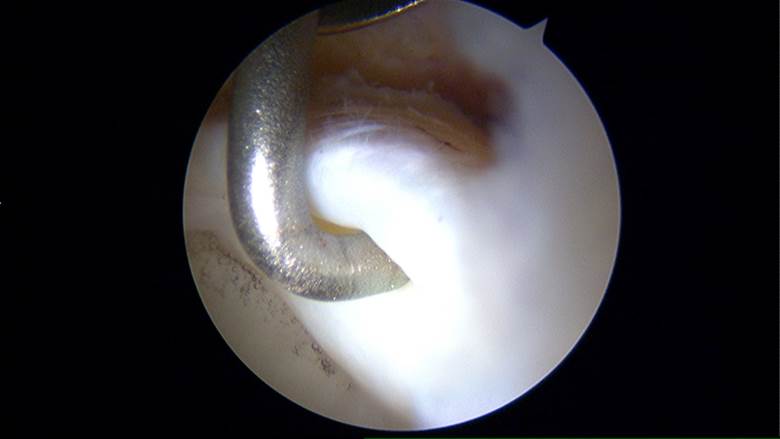 The Hip Labrum: What Is It? What Happens When It Tears? How Are Tears ...