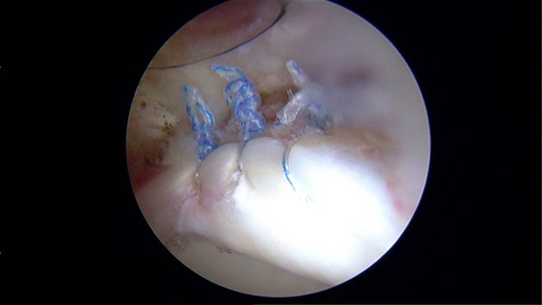 The Hip Labrum: What Is It? What Happens When It Tears? How Are Tears ...