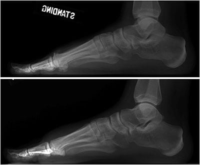 Arthritis of the Big Toe (Hallux Rigidus): What Are My Treatment ...