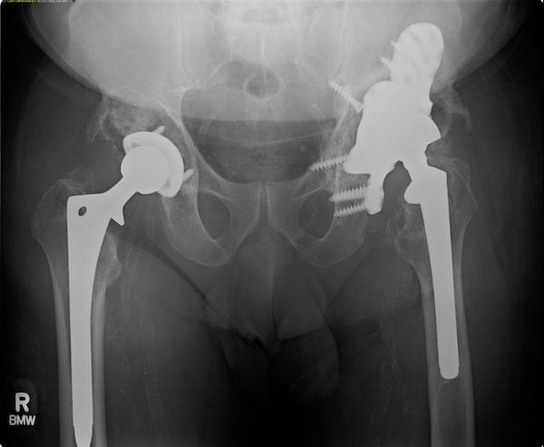Revision Total Hip Replacement | Dr. Michael Wind