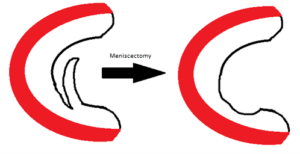 Meniscus Tears: Why Are Some Repaired and Others Excised? | OrthoVirginia